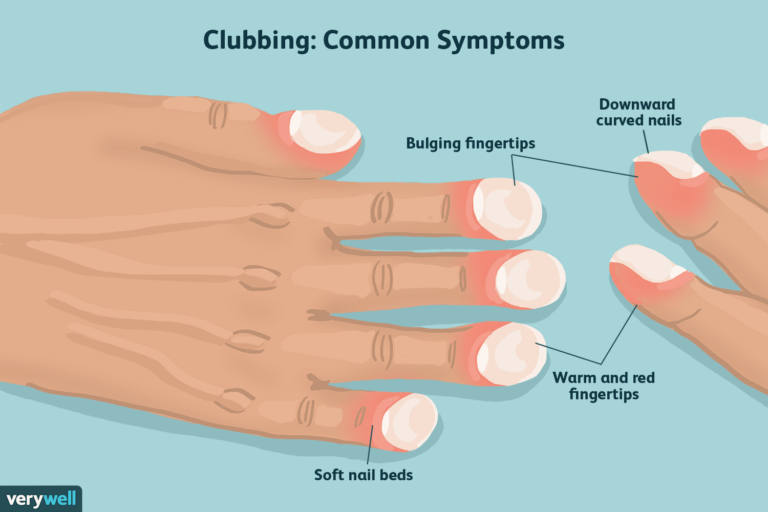What is Nail Clubbing? The Causes, Care, and Treatment of Clubbed Nails